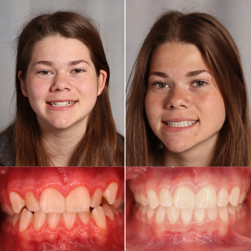 PRD Smile Gallery | Prairie Run Dental