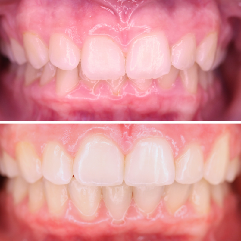 PRD Smile Gallery | Prairie Run Dental